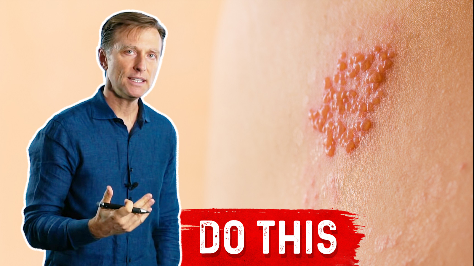 5 Natural Remedies for Ringworm and Prevention Tips