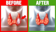 How To Shrink Thyroid Nodules Naturally Healthy Keto Dr Berg