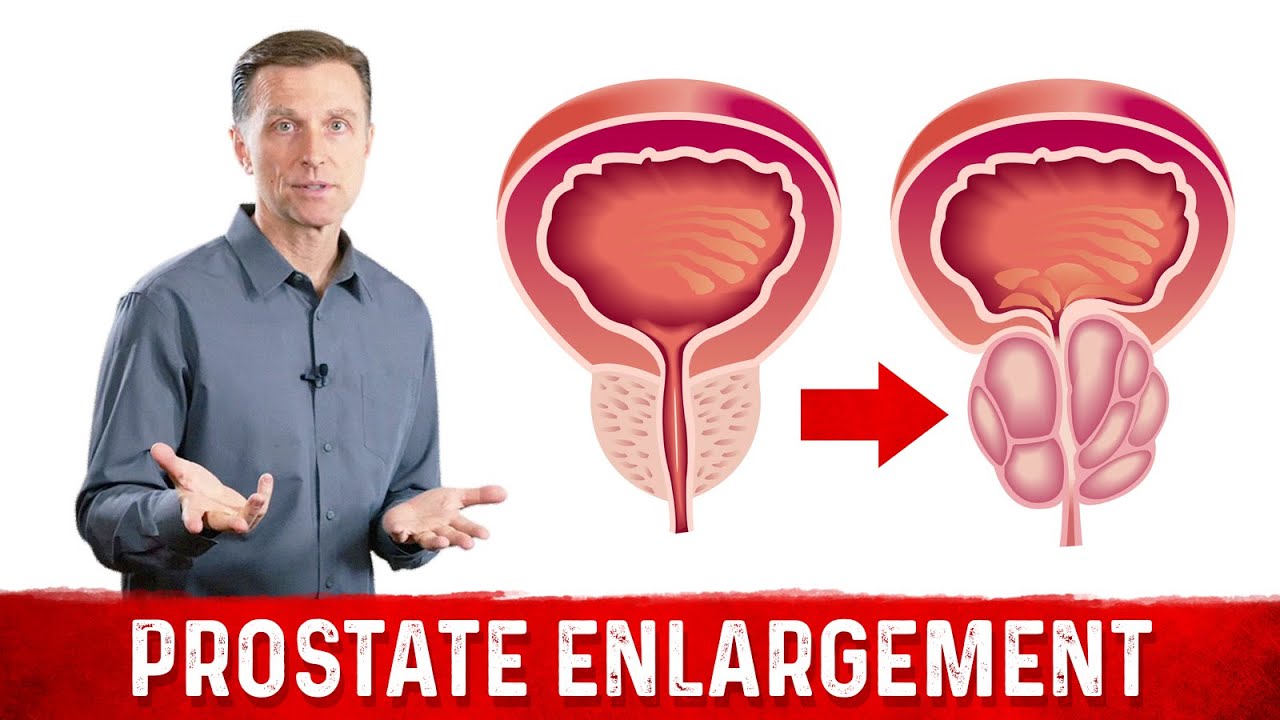 Prostate Enlargement The True Cause| Dr. Berg