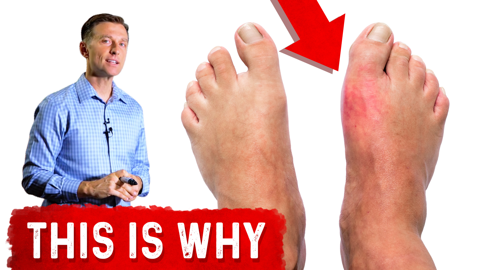 Why Do You Get Gout In Your Big Toe Healthy Keto™ Dr Berg