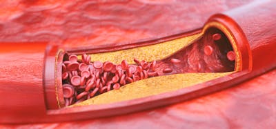Vitamins & Other Nutrients That Remove Arterial Plaque | Dr. Berg