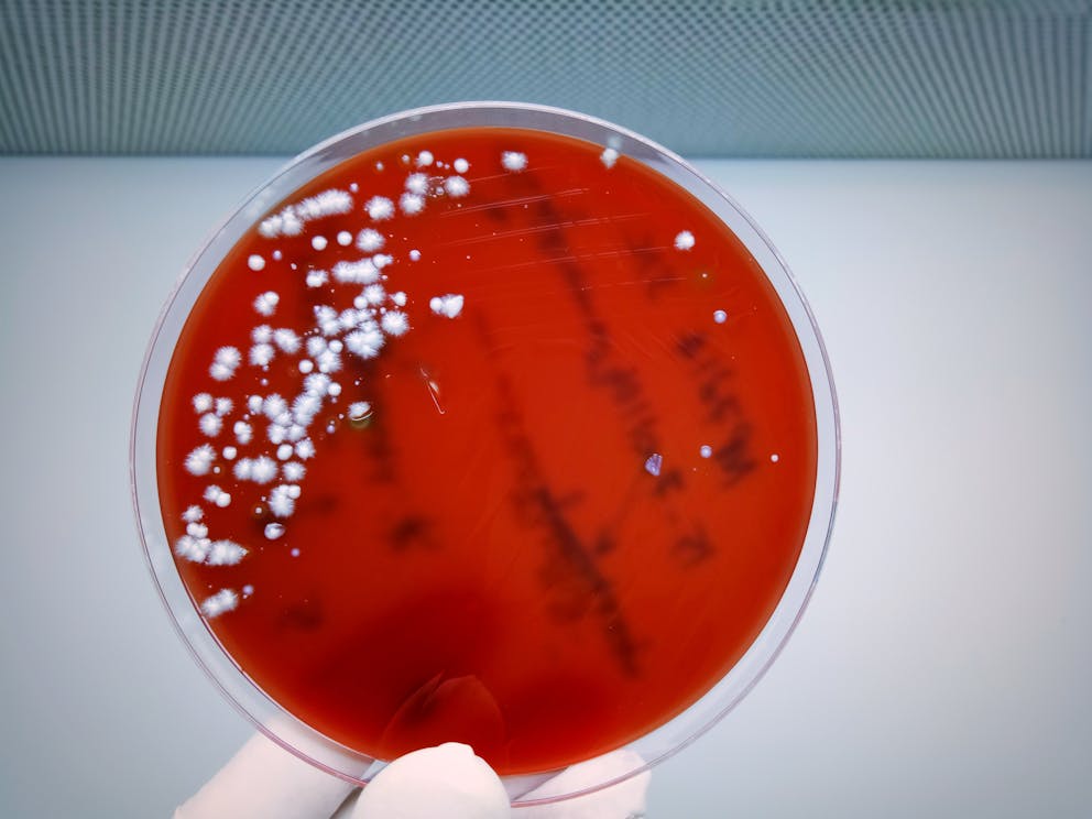 Understanding Candida and the Strongest Candida Killer | Dr. Berg