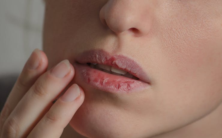 Discolored or Dry Lips Can Indicate Vitamin Deficiency | Dr. Berg