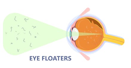 How to Reduce Floaters in Eyes Naturally | Dr. Berg