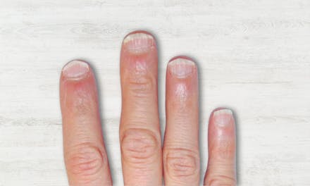 What Causes Spoon-Shaped Nails? | Dr. Berg