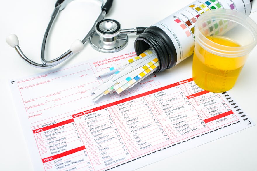 High pH in Urine: Symptoms, Causes, and How to Test | Dr. Berg
