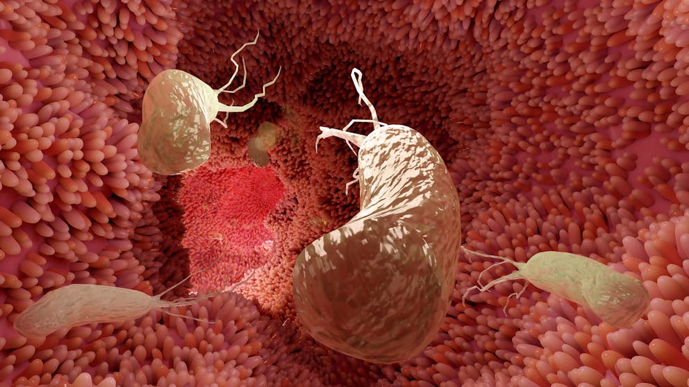 How to Fix a Stomach Ulcer—5 Natural Remedies | Dr. Berg