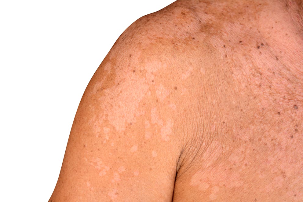 Tinea Versicolor Natural Remedies | Dr. Berg