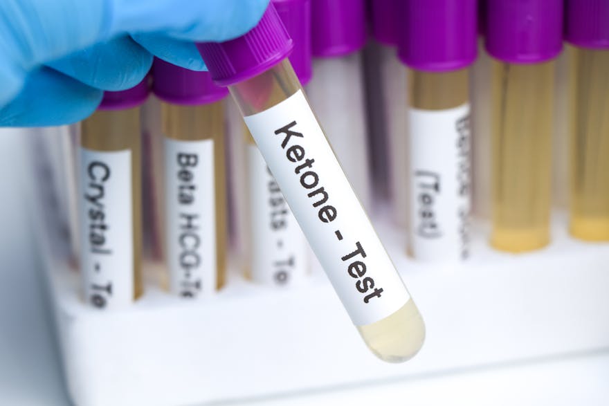 Low or No Ketones in Urine While on Keto—Why? | Dr. Berg