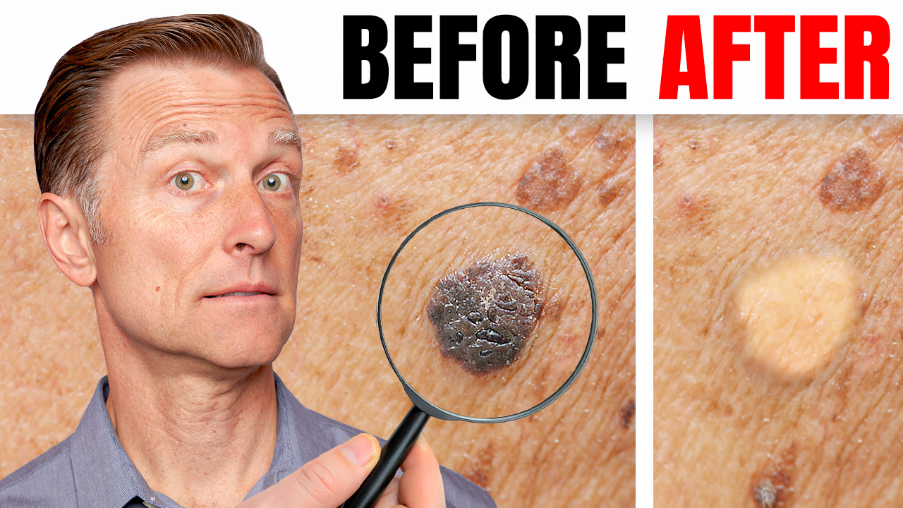 Dr. Berg's Overnight Fix for Skin Tags and Warts