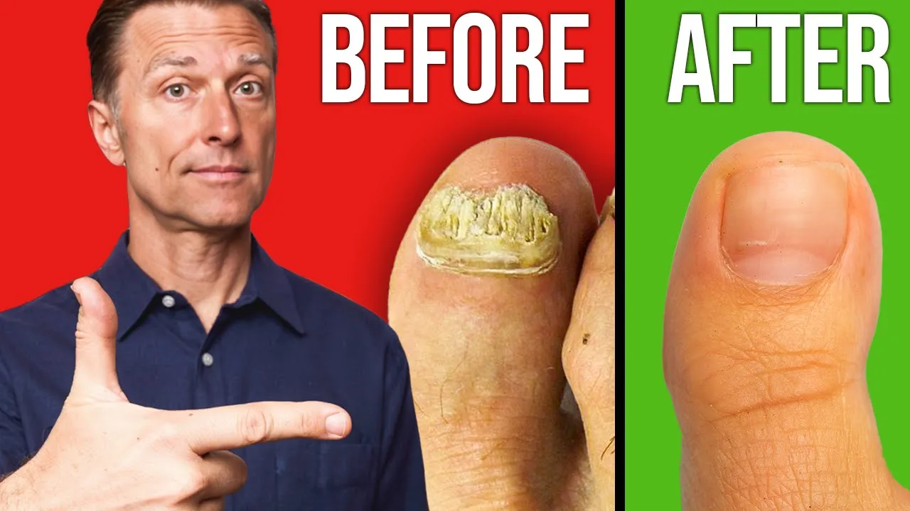 Get Rid of Toenail Fungus Fast with Dr. Berg’s Tips